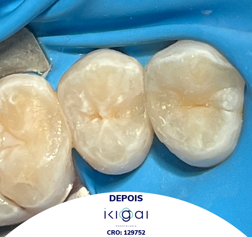 restauração em resina composta – Ikigai Odontologia
